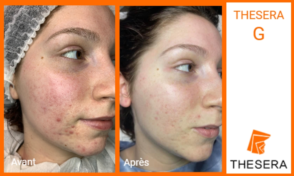 Soins pour la peau Thesera